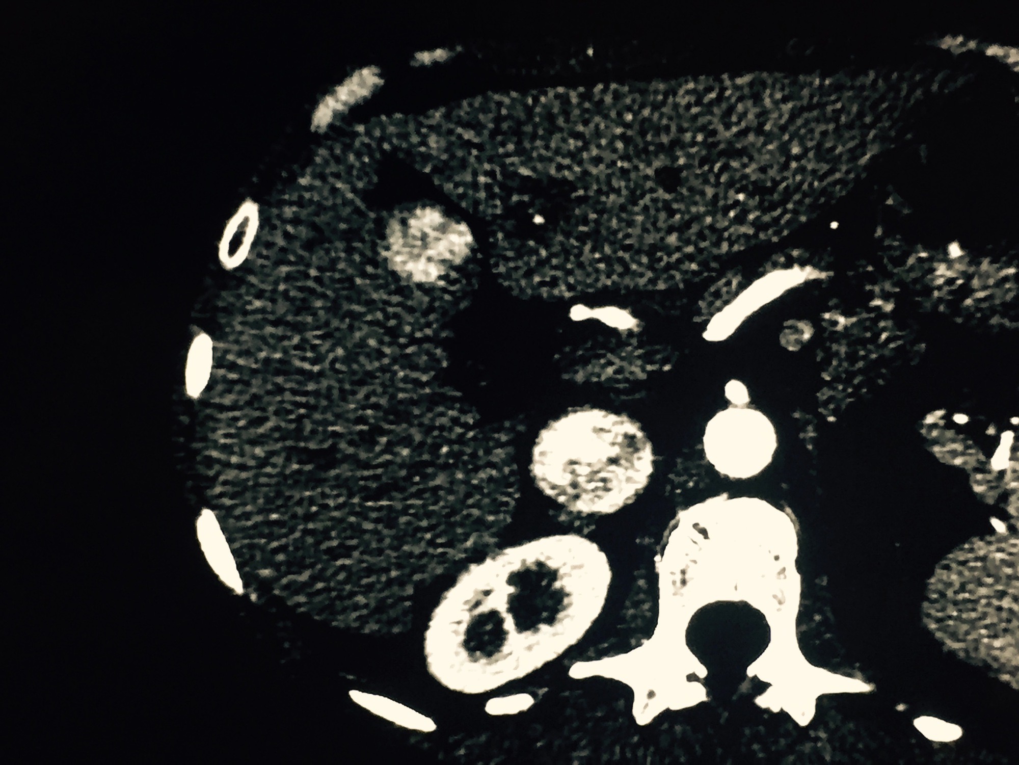 Mri Cancer Spot On Liver Karen I Help C